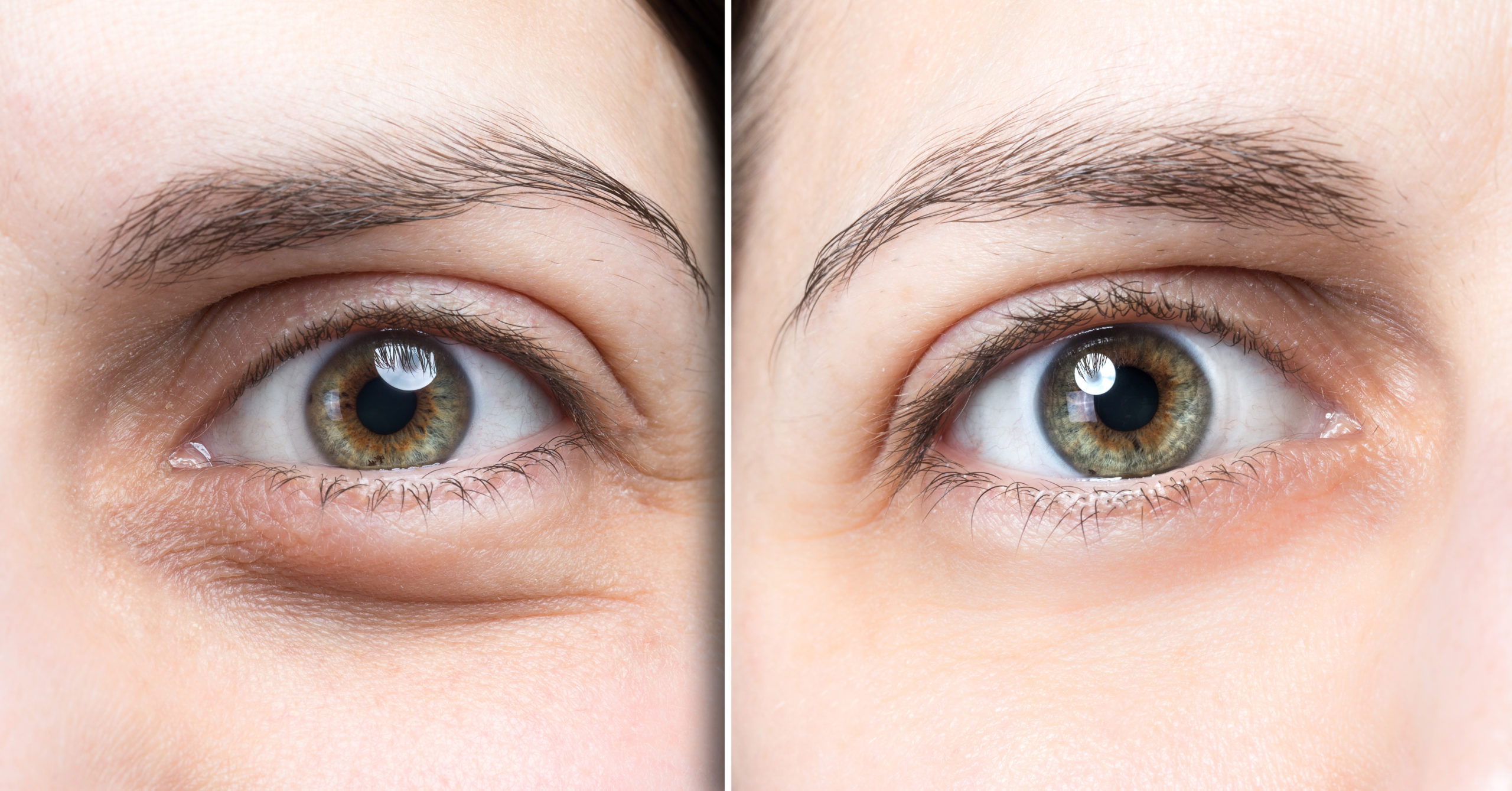 The Art of Facial Balancing with Dermal Fillers